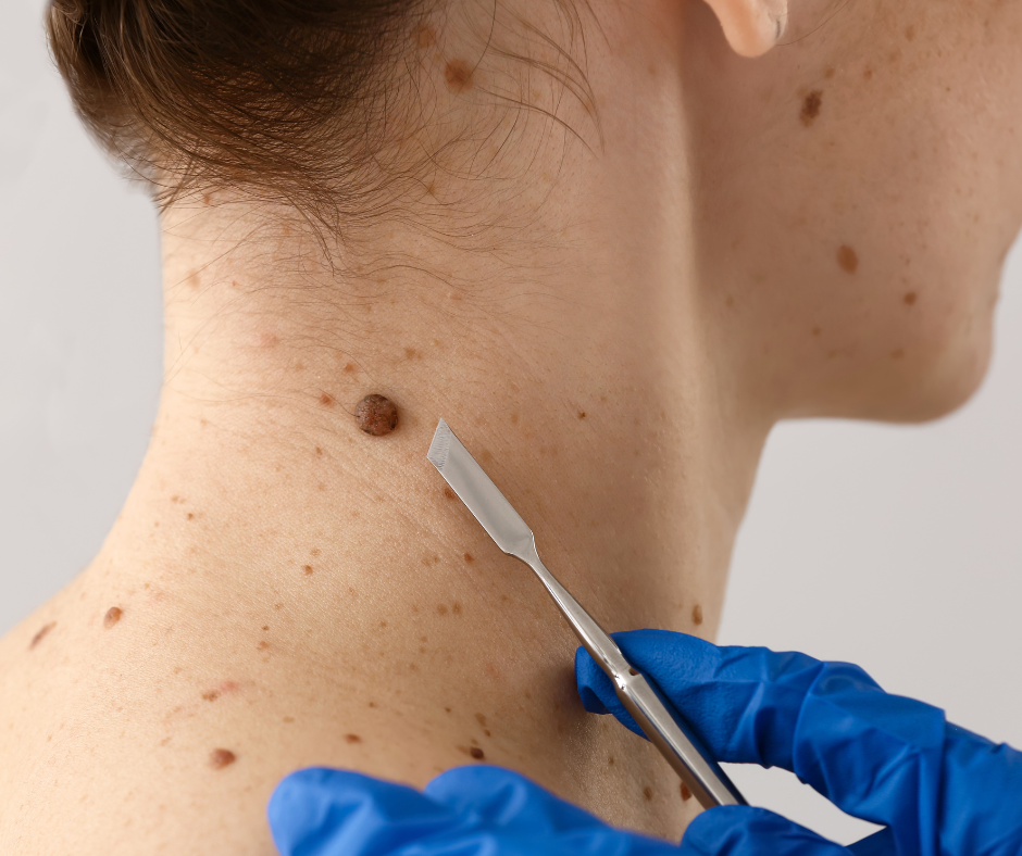 Mole Removal – carencampbellmd