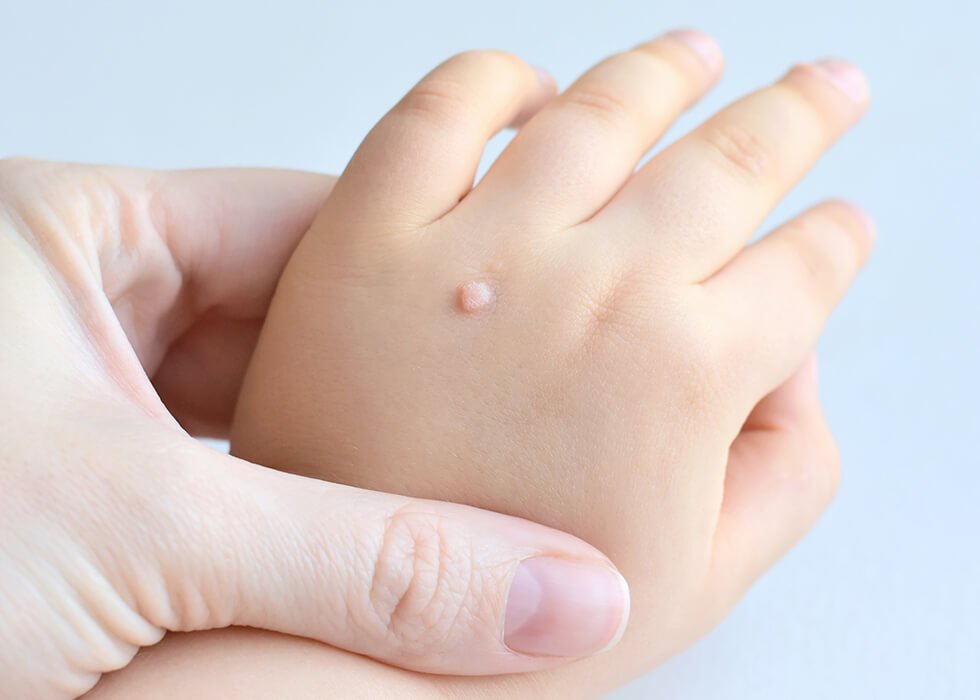Warts — San Francisco Dermatology | Best Dermatologist Bay Area ...