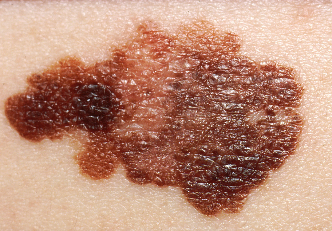 Skin Cancer — San Francisco Dermatology | Best Dermatologist Bay Area ...