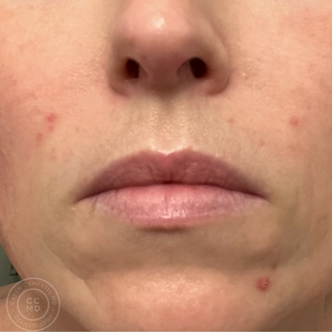 Before and After: Perioral Dermatitis – carencampbellmd