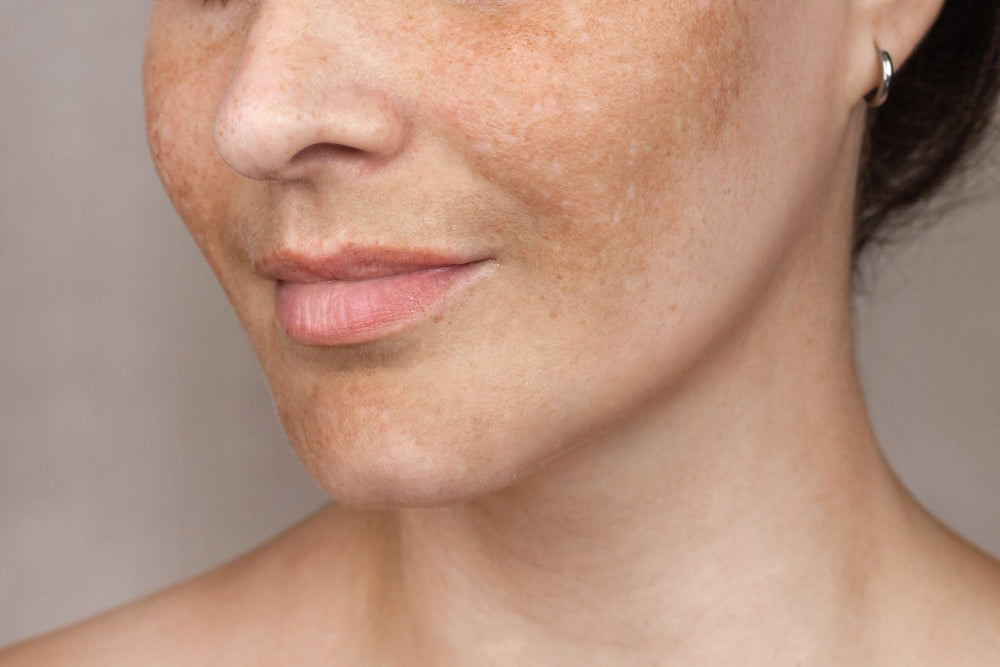 San Francisco Melasma Treatments — San Francisco Dermatology | Best ...